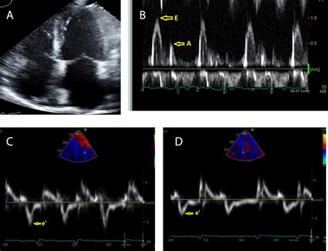 Restrictive Cardiomyopathy Icd 10