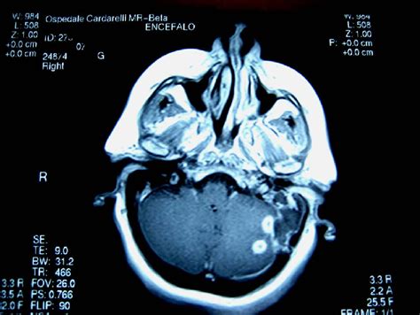Two Nodules In The Left Cerebellar Hemisphere Download Scientific