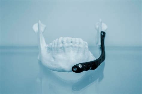 3d 프린트된 플라스틱 프로토타입 인간의 아래턱 및 의료용 티타늄 임플란트 근접 촬영 검정색 보철물 프로토타입 금속 분말로