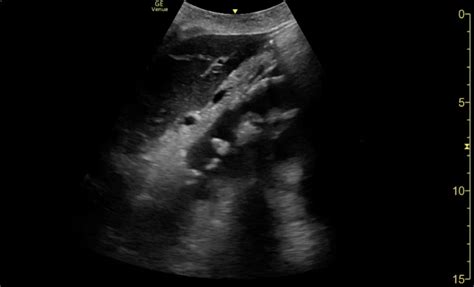 Aortic Dissection Case Report Jetem