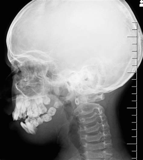 Gorham S Disease Pacs