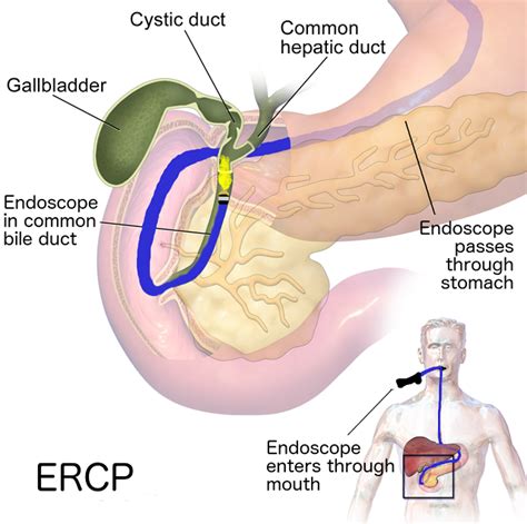 Case Report ERCP PerLove