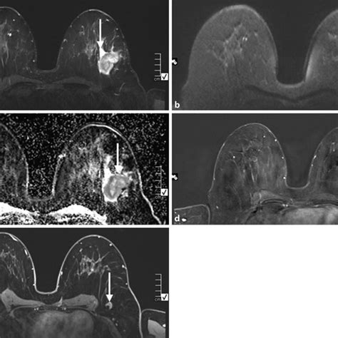 Mri Of The Histopathologically Confirmed Phyllodes Tumor In The Left