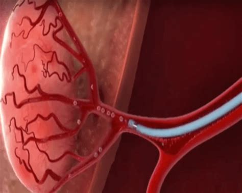 Prostatic Artery Embolization In South Africa 01 Prostate Care