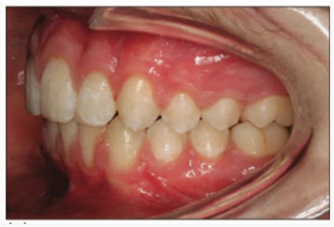 Molar And Canine Occlusions Flashcards Quizlet