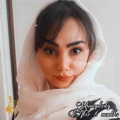 عکس دختر بعد از عمل بینی