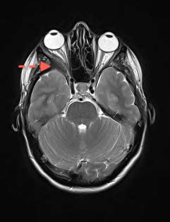 Primary Intraosseous Meningioma Of The Right Greater Sphenoid Wing