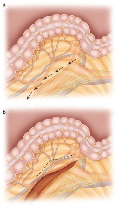Laparoscopic Rectopexy Abdominal Key