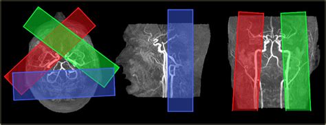The Radiology Assistant Vascular Territories Of The Brain