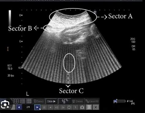 Mahmoud Ragab On Linkedin Electrical Interference Artifact Is An