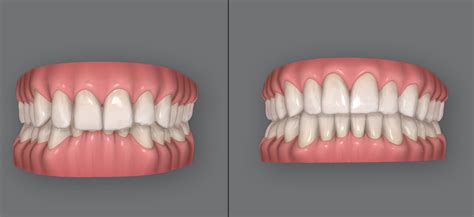 Overbite Correction Before And After Pictures Can Invisalign Fix