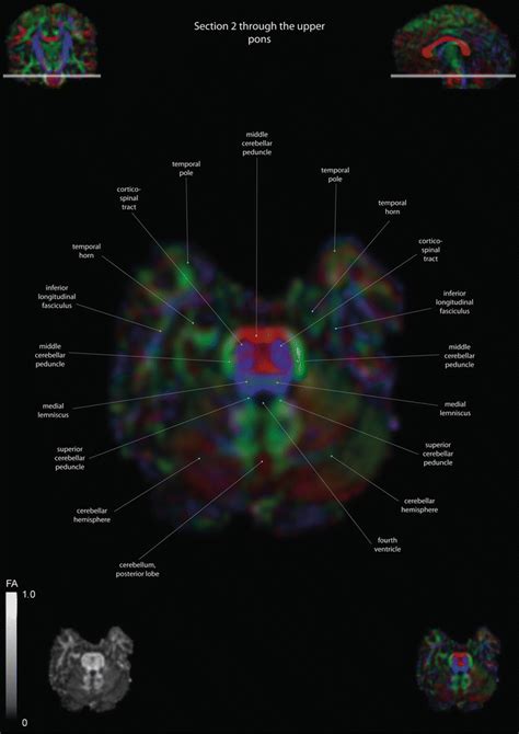 Normal Diffusion Tensor Imaging Based White Matter Anatomy Radiology Key