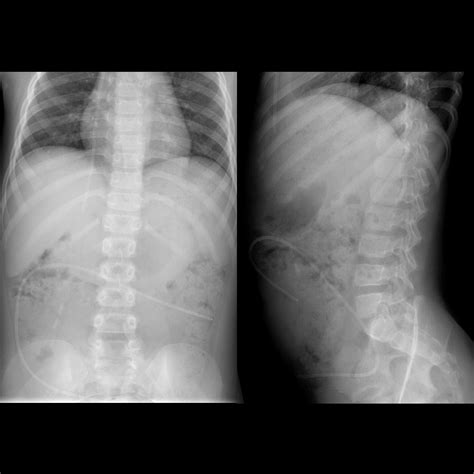 Pediatric Ventriculoperitoneal Shunt Malfunction Malposition
