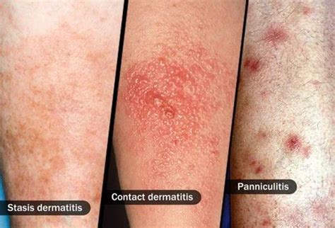 Panniculitis Vs Cellulitis Panniculitis Types Symptoms Treatment