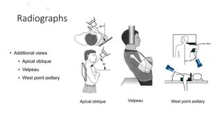 Upper Extremity Shoulder Fracture Pptx
