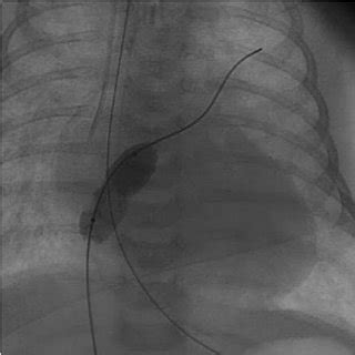 Balloon Atrial Septostomy Using Static High Pressure Balloon Download Scientific Diagram