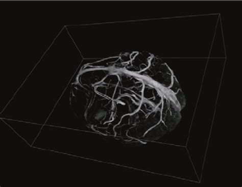 The Same Tof Mra Dataset Volume As In Figure 6 But Masked With The