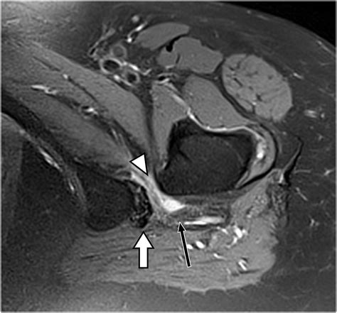 Ischiofemoral Impingement Syndrome In 2024 Magnetic Resonance Imaging
