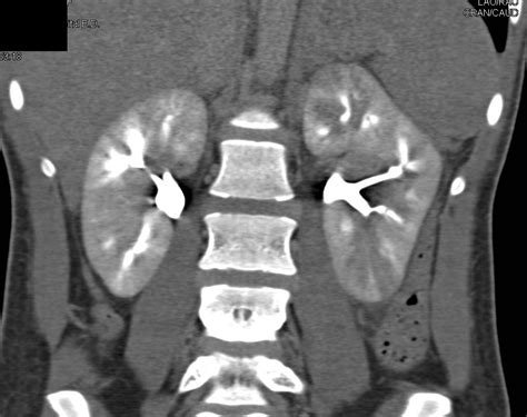 Acute Pyelonephritis With Patchy Nephrogram Best Seen On Late Phase
