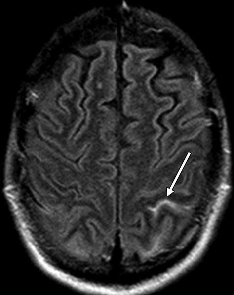 Subarachnoid Hemorrhage Aneurysm