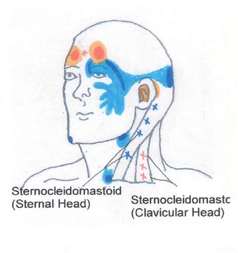 Sternocleidomastoid Trigger Points