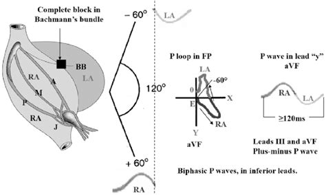 Outline Of Atrial Activation In Advanced Interatrial Block A Iab Download Scientific Diagram Outline Of Atrial Activation In Advanced Interatrial Block A Iab Download Scientific Diagram