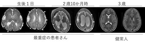 大脳皮質形成異常症の1つである多小脳回 病的に小さい脳回が多発する病気 の新たな原因遺伝子ATP1A3を同定 テックアイ生命科学