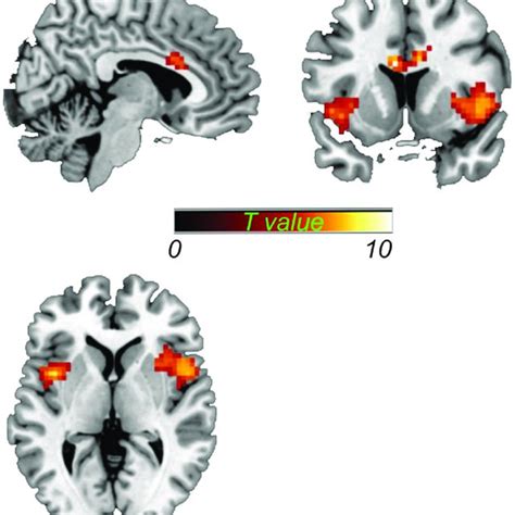 Group Difference Of Global Functional Connectivity Density Gfcd Map