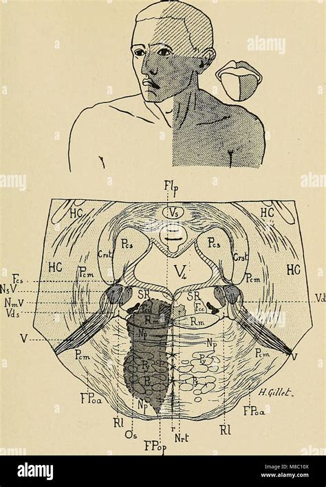 Diseases Of The Nervous System 1915 Is A Textbook Covering Neurological And Psychiatric