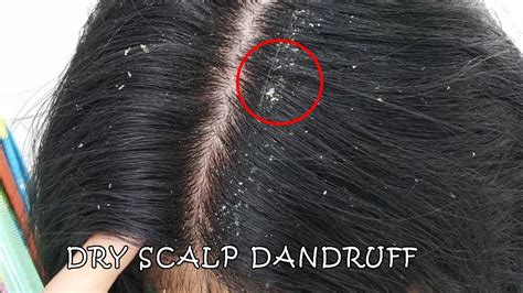 Dry Scalp Vs Lice