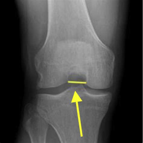 Arthroscopic View Of A Left Intercondylar Notch From A Standard Lateral