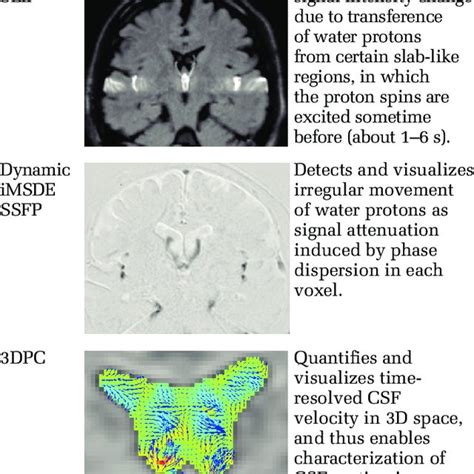 Cerebrospinal Fluid Csf Motion In A Healthy Individual Visualized