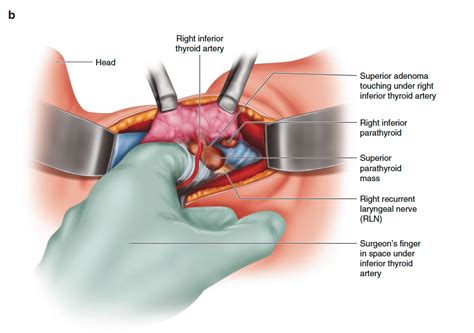 Identification Of The Superior Parathyroid Gland Rodrigo Arrangoiz Ms