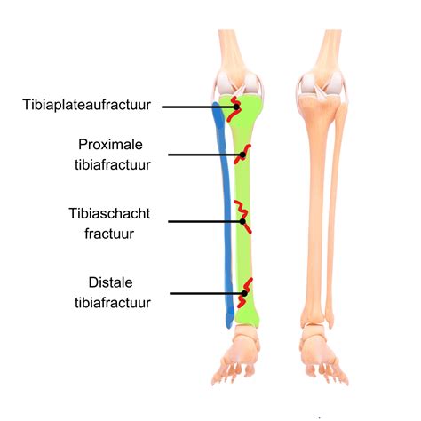 Herstel Van Een Gebroken Scheenbeen Revalidatiegidsnl