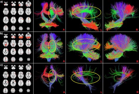 Fmri Activation Maps And Fmri Guided Ensemble Tracts For A Hc B Amci