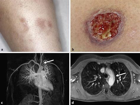 Pyoderma Gangrenosum And Erythema Nodosum Revealing Takayasus