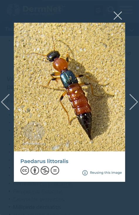 Is It “paederus Dermatitis” R Cambodia