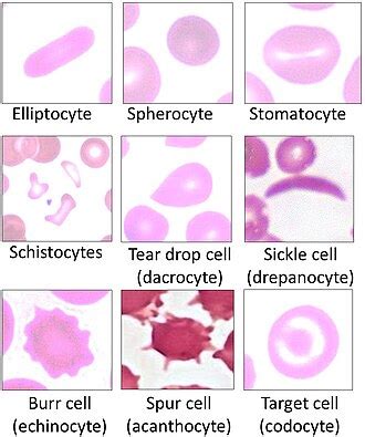 Hereditary Stomatocytosis Wikipedia