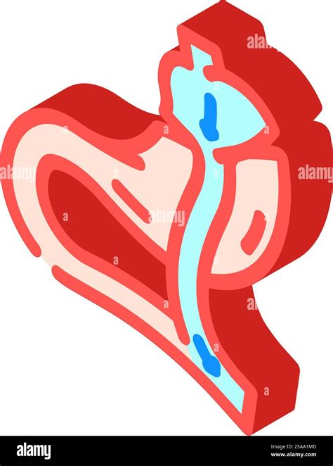 Gastric Bypass Surgery Isometric Icon Vector Gastric Bypass Surgery