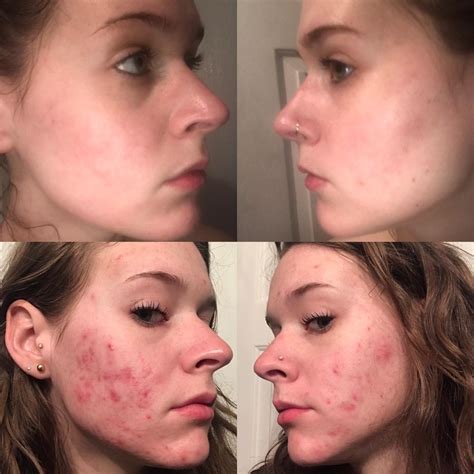 4 Month Update 1 Month On Doxycycline And Veltin And 3 On Accutane I