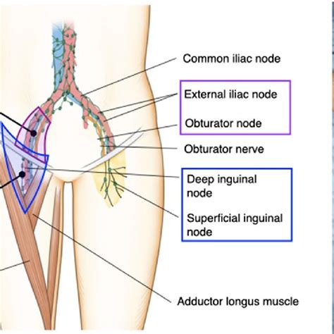 Schematic Representations Of Inguino Pelvic Lymphadenectomy Inguinal