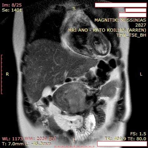 Desmoid Tumor Recurrence