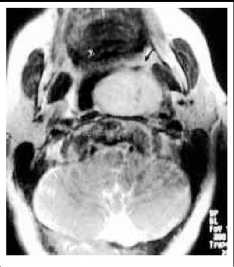 Figure 1 From Synovial Cell Sarcoma Of The Neck Case Report And Review Of The Literature