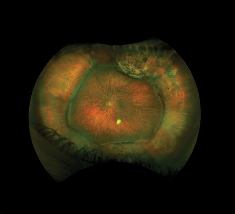 Myopic Refraction With Scleral Buckle Modern Optometry