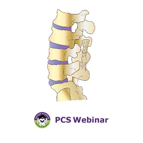 Icd 10 Pcs Coding For Spinal Fusions Straight To The Point