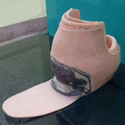 Passive Prosthetic Round Ankle Length Symes Prosthesis For Syme Amputation At ₹ 9000piece In Patna