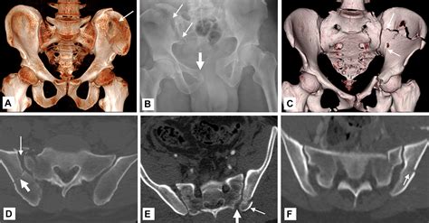 Iliac Wing Fracture Recovery Time