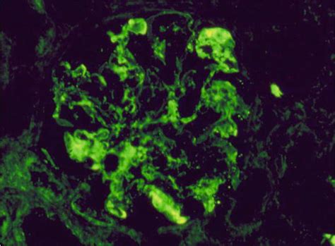 Glomerular Tubulointerstitial And Vascular Diseases Abdominal Key