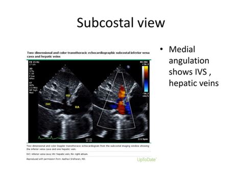 2d Transthoracic Echocardiographic Views Ppt Death Injury Or