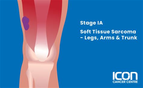 Soft Tissue Sarcoma Types Signs Symptoms And Stages Icon Cancer